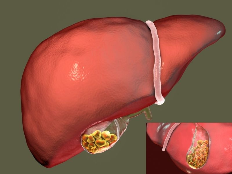 Safra Kesesi ve Hastalıkları - Genel Cerrahi Uzmanı